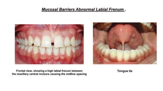 Common etiological factors of malocclusion | PPTX