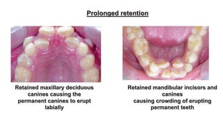 Common etiological factors of malocclusion | PPTX