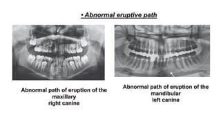 Common etiological factors of malocclusion | PPTX
