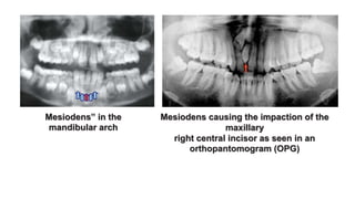 Common etiological factors of malocclusion | PPTX