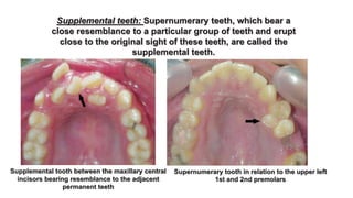 Common etiological factors of malocclusion | PPTX
