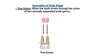 Common etiological factors of malocclusion | PPTX