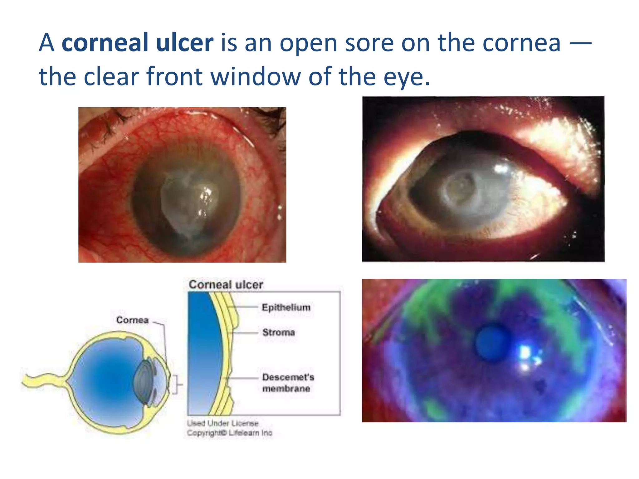 Common eye disease | PPTX