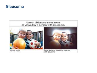 Common eye disease | PPTX