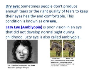 Common eye disease | PPTX