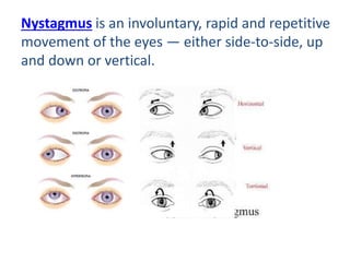 Common eye disease | PPTX