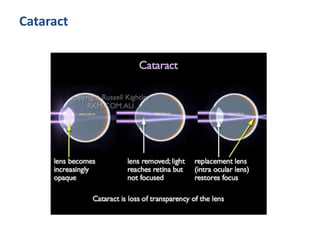 Common eye disease | PPTX