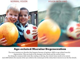 Common eye disorders that most people face | PDF