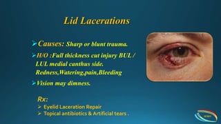 Common eye injury | PPT