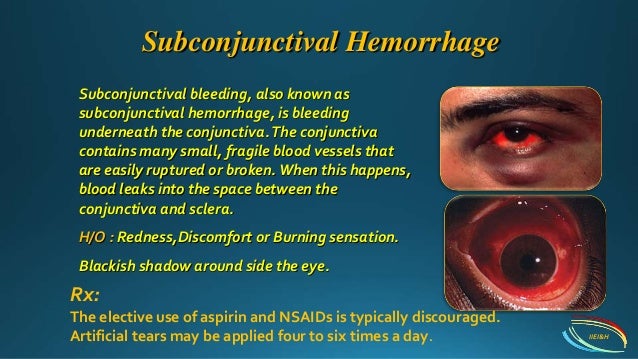Common eye injury