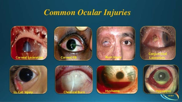 Common eye injury