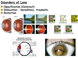 Common Eye Problem | PPT