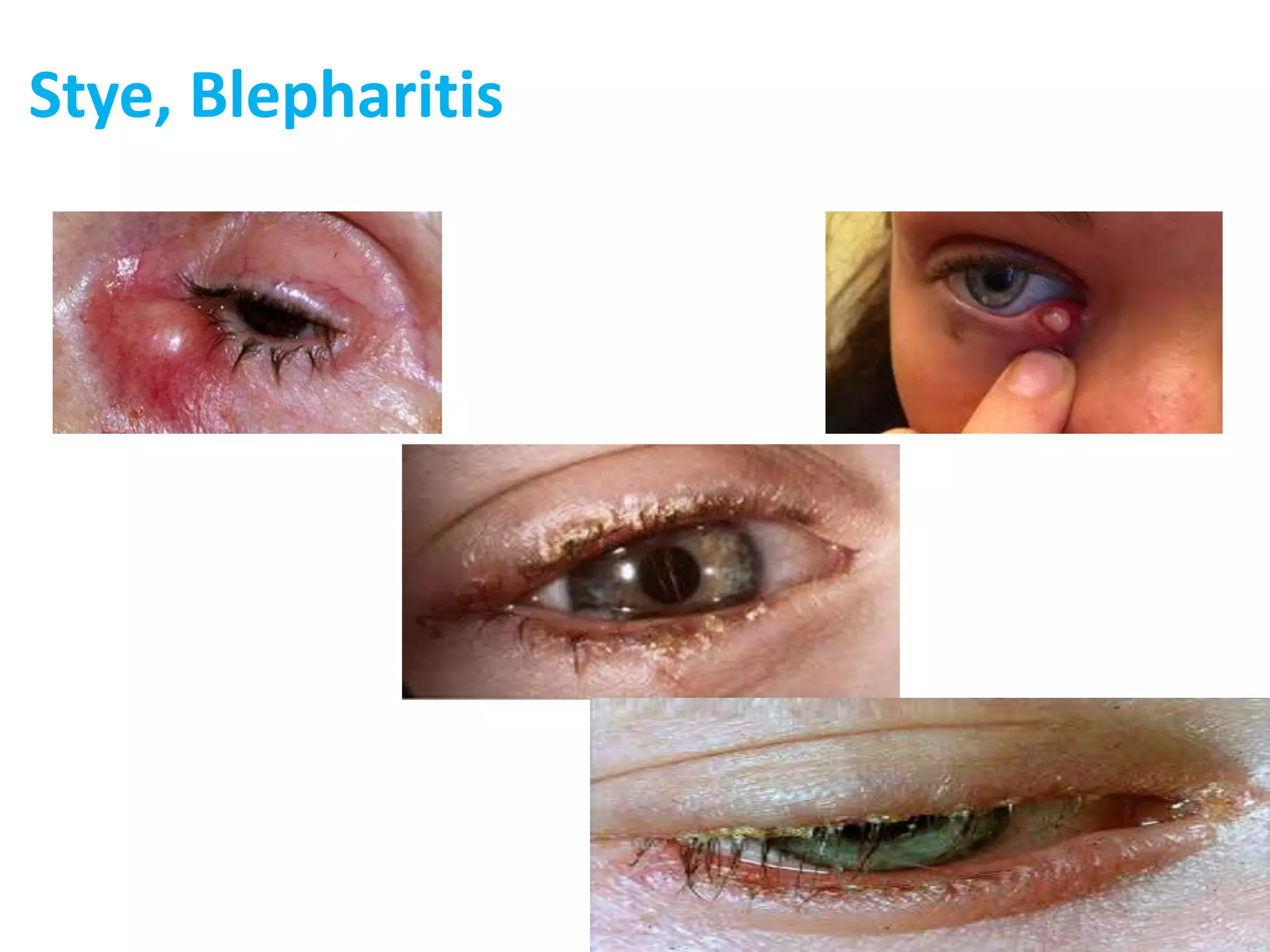 Common eye problem corneal ulcer, glaucoma, cataract, diabetic retinopathy, dd of red eyes | PPTX