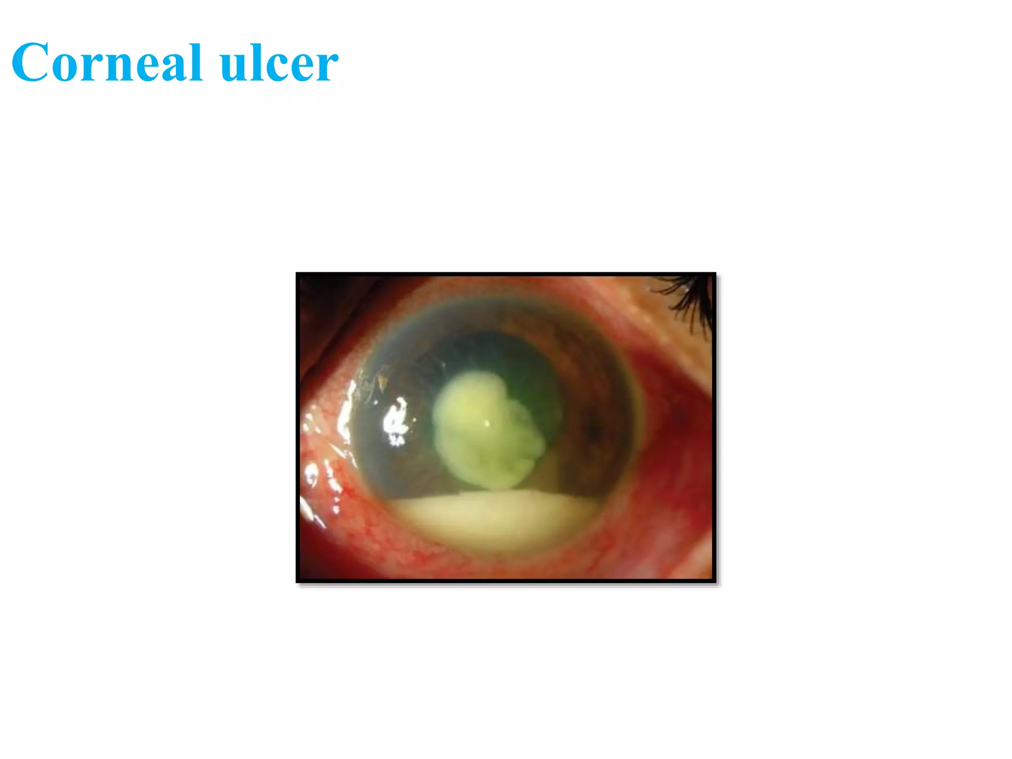 Common eye problem corneal ulcer, glaucoma, cataract, diabetic ...