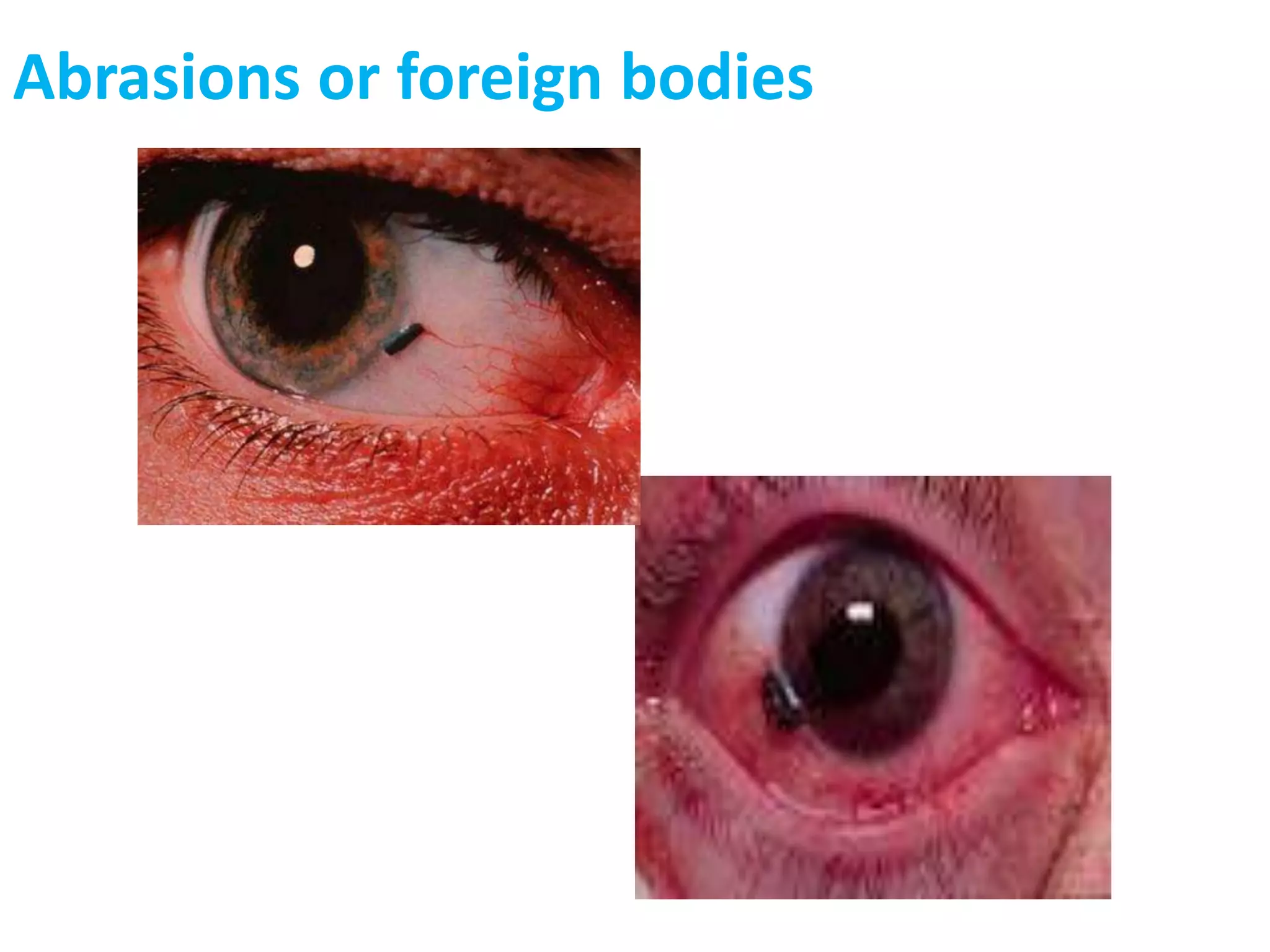 Common eye problem corneal ulcer, glaucoma, cataract, diabetic retinopathy, dd of red eyes | PPTX