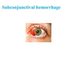 Common eye problem corneal ulcer, glaucoma, cataract, diabetic ...