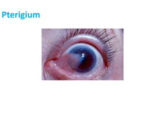 Common eye problem corneal ulcer, glaucoma, cataract, diabetic ...