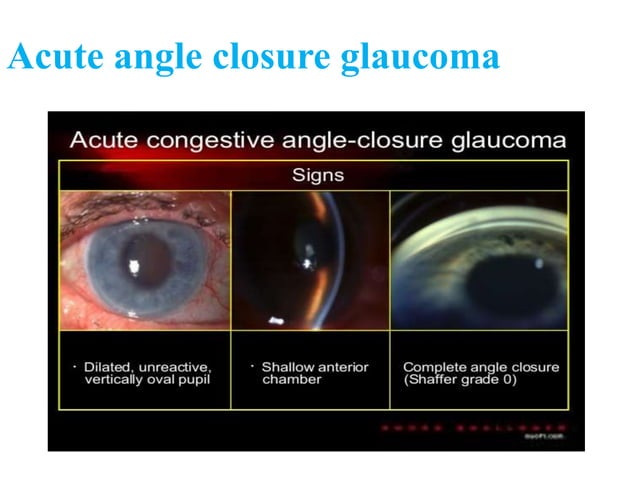 Common eye problem corneal ulcer, glaucoma, cataract, diabetic ...