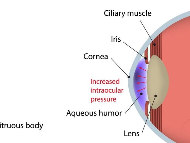 Common eye problem corneal ulcer, glaucoma, cataract, diabetic ...