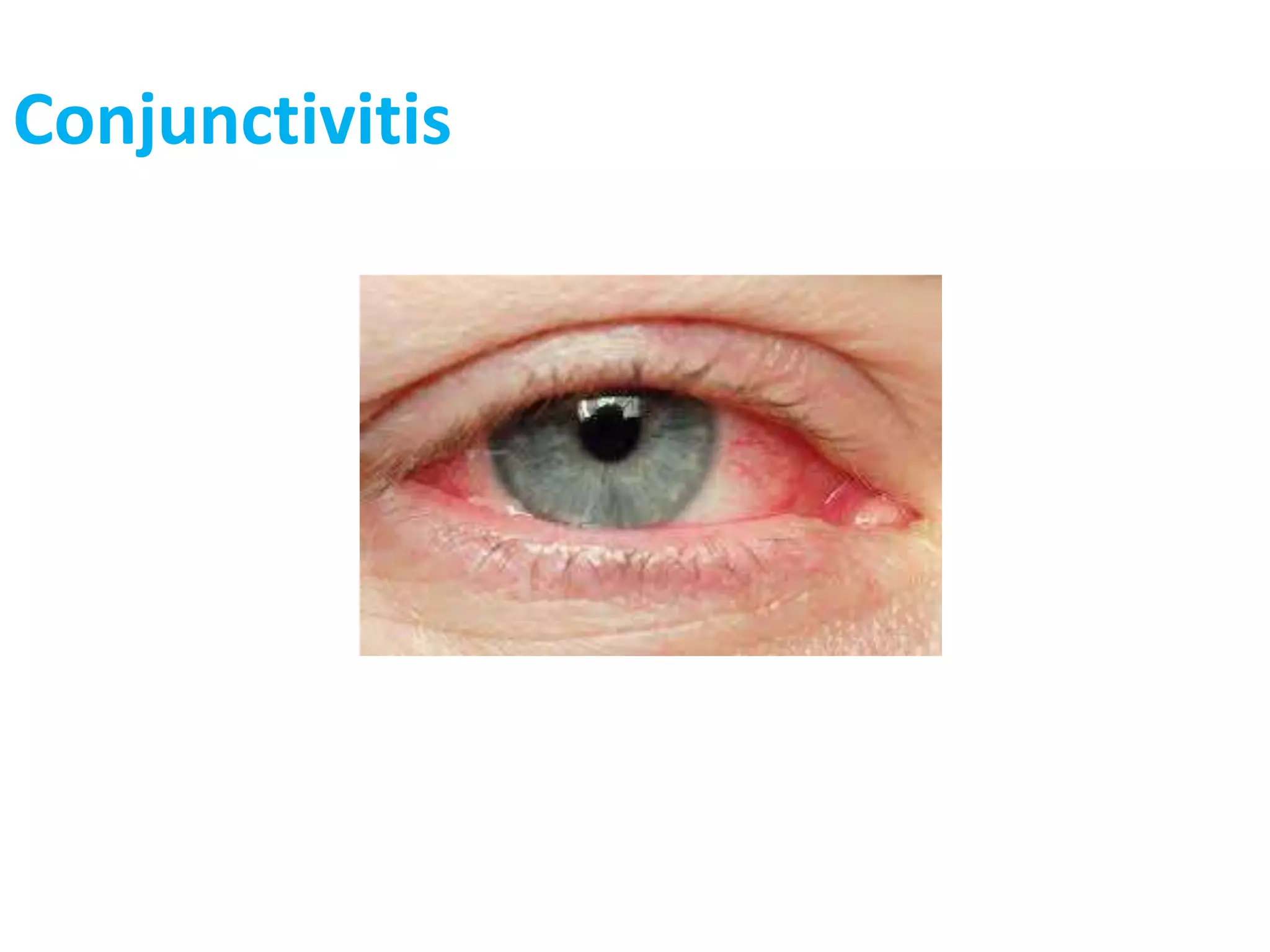 Common eye problem corneal ulcer, glaucoma, cataract, diabetic ...