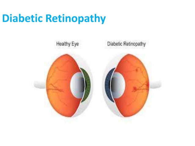 Common eye problem corneal ulcer, glaucoma, cataract, diabetic ...