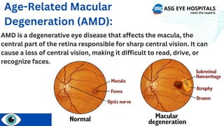 Common Eye Problems | PDF