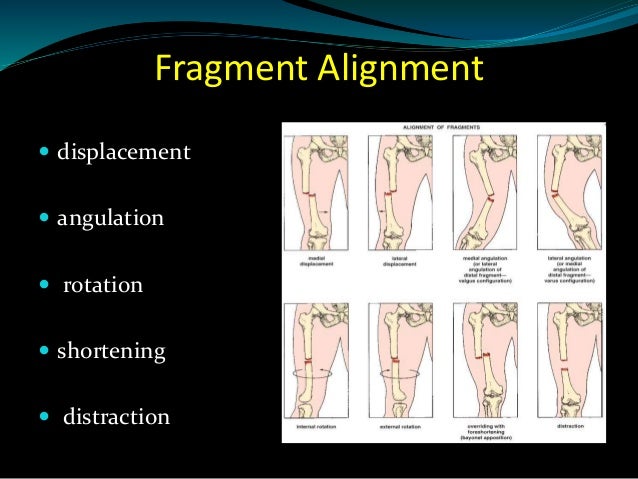 Common fractures svh jmo