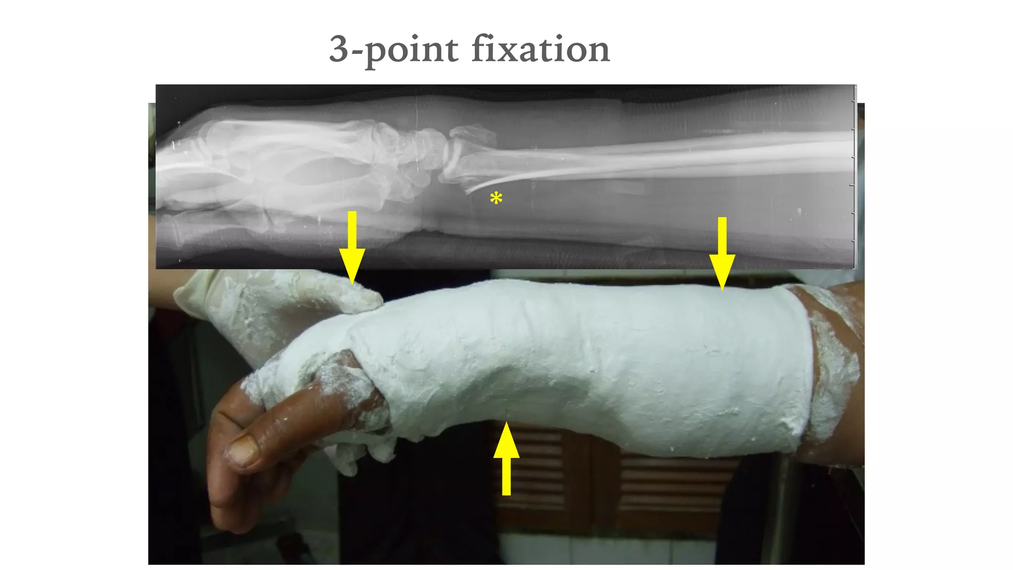 Common Hand Fractures & Dislocations | PDF