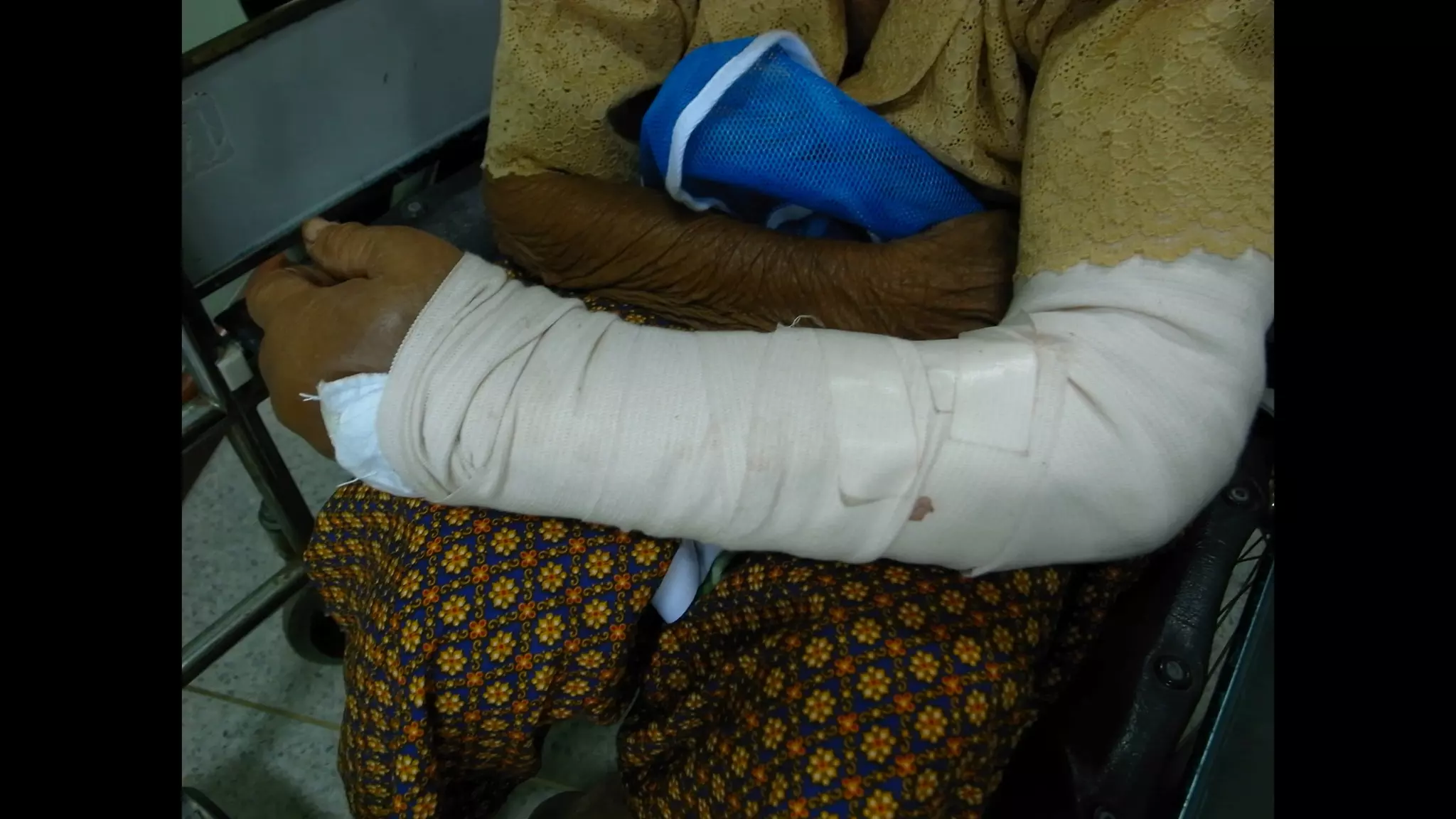 Common Hand Fractures & Dislocations | PDF