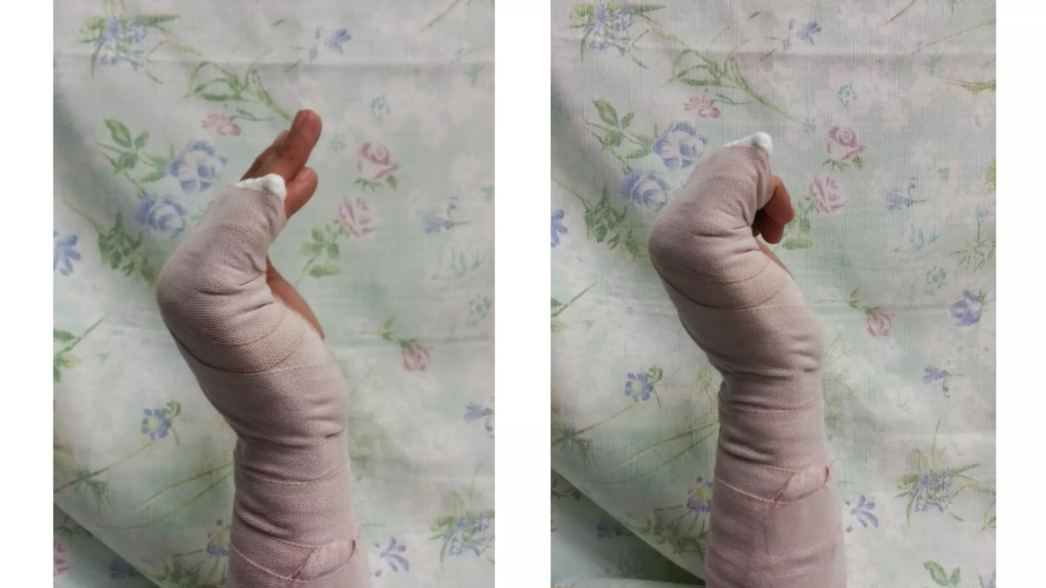 Common Hand Fractures & Dislocations | PDF | First Aid | Injuries