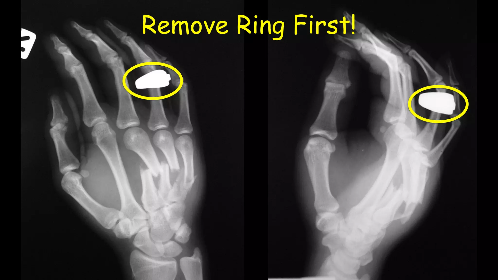 Common Hand Fractures & Dislocations | PDF