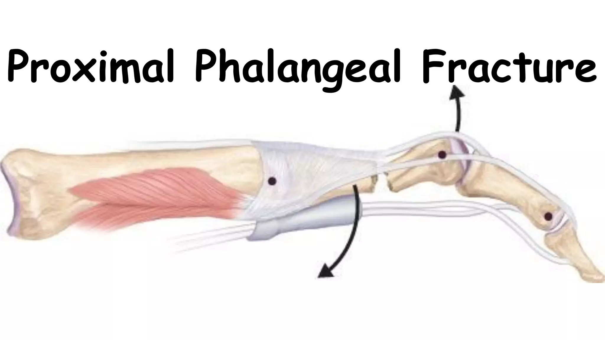 Common Hand Fractures & Dislocations | PDF