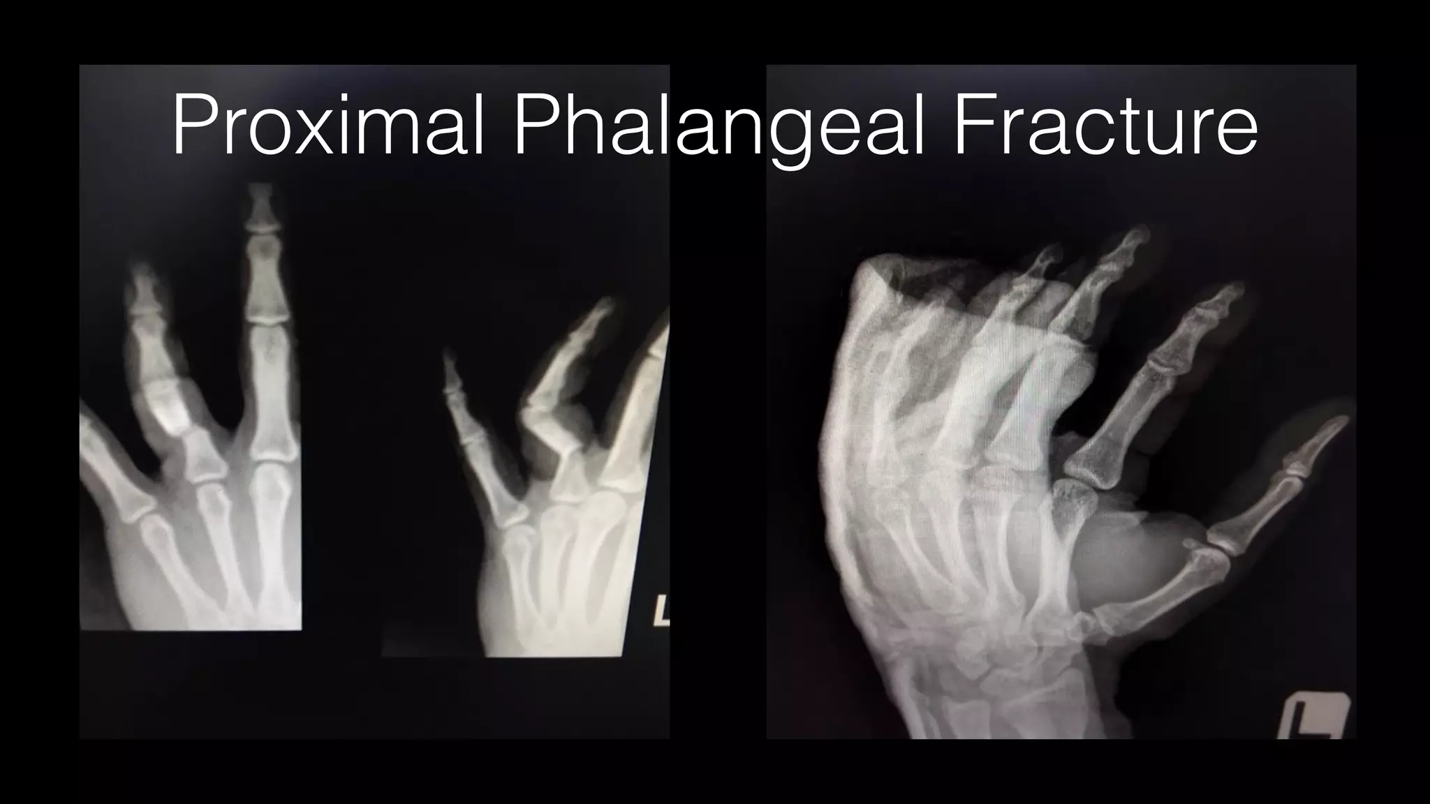 Common Hand Fractures & Dislocations | PDF