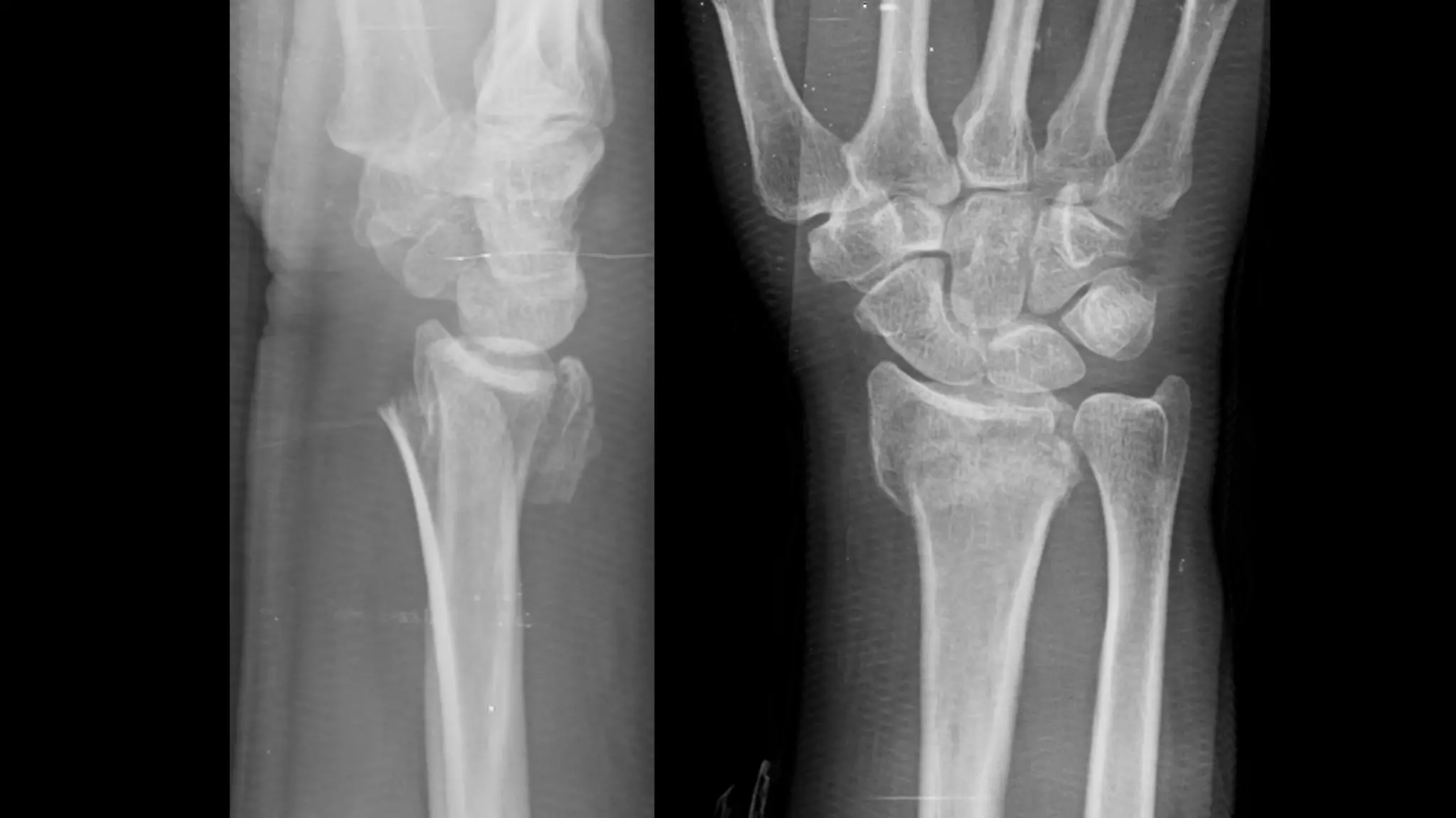 Common Hand Fractures & Dislocations | PDF