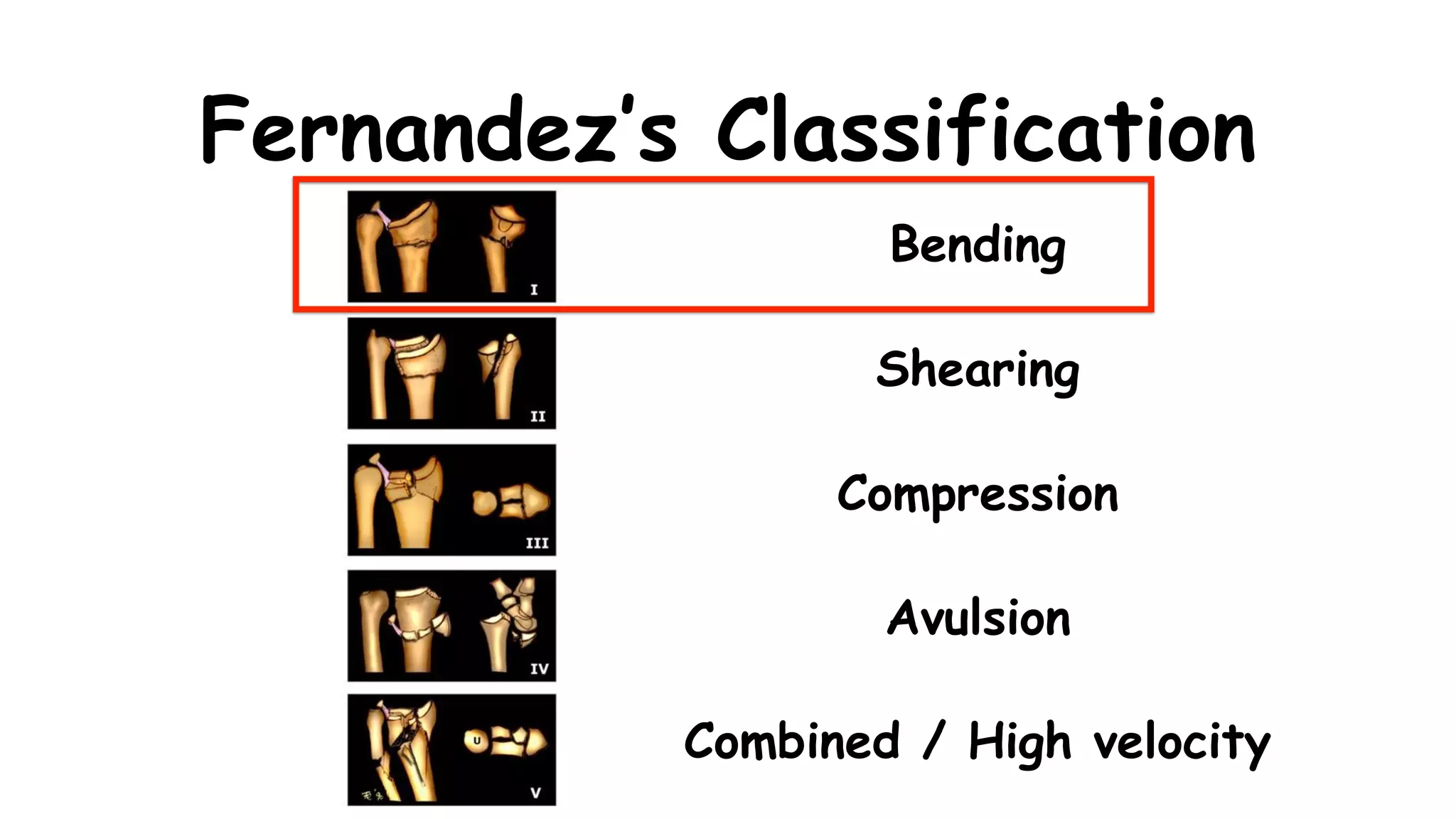 Common Hand Fractures & Dislocations | PDF