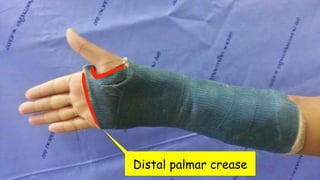 Common Hand Fractures & Dislocations | PDF