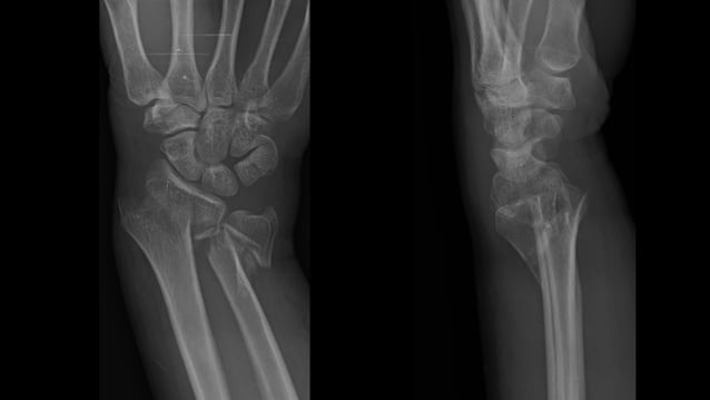 Common Hand Fractures & Dislocations | PDF | First Aid | Injuries