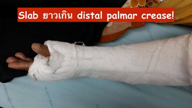 Common Hand Fractures & Dislocations | PDF | First Aid | Injuries