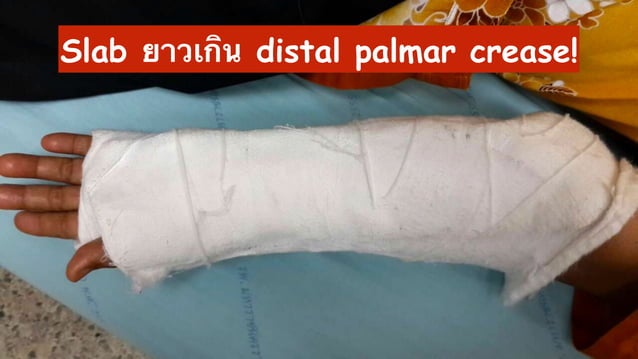 Common Hand Fractures & Dislocations | PDF | First Aid | Injuries