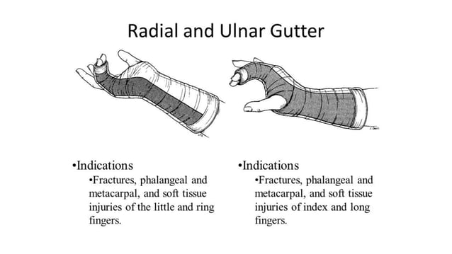Common Hand Fractures & Dislocations | PDF | First Aid | Injuries