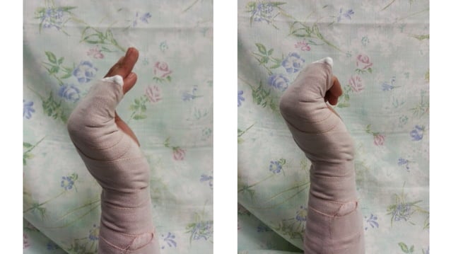 Common Hand Fractures & Dislocations | PDF | First Aid | Injuries