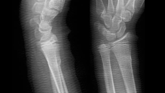 Common Hand Fractures & Dislocations | PDF | First Aid | Injuries