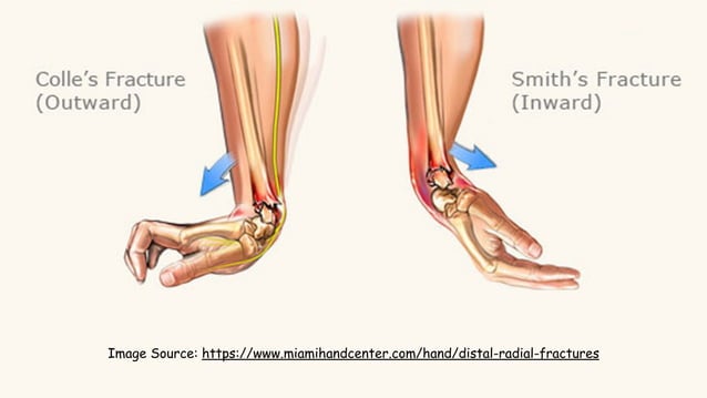 Common Hand Fractures & Dislocations | PDF | First Aid | Injuries