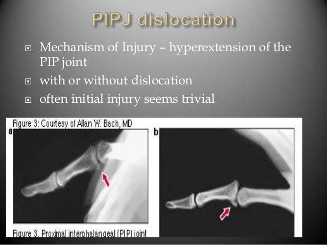 Common hand injuries