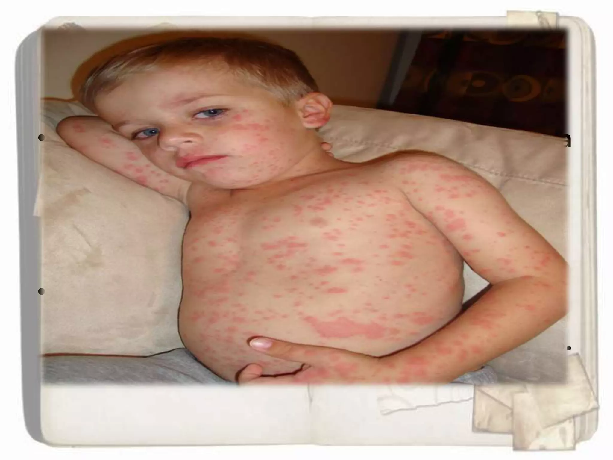 Common illnesses | PPTX