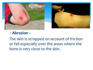 COMMON INJURIES AND FIRST AID.pptx