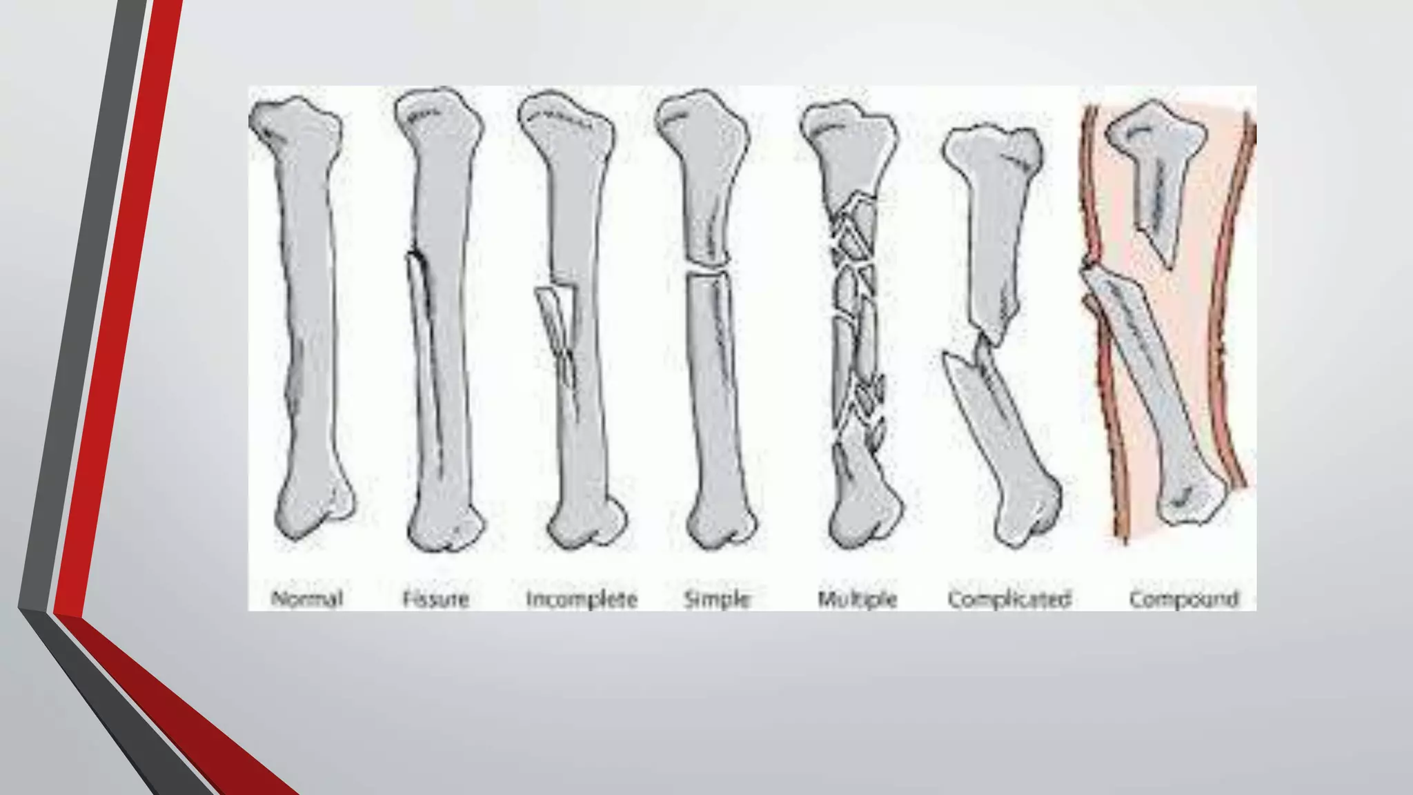 Common injuries during recreation | PPTX