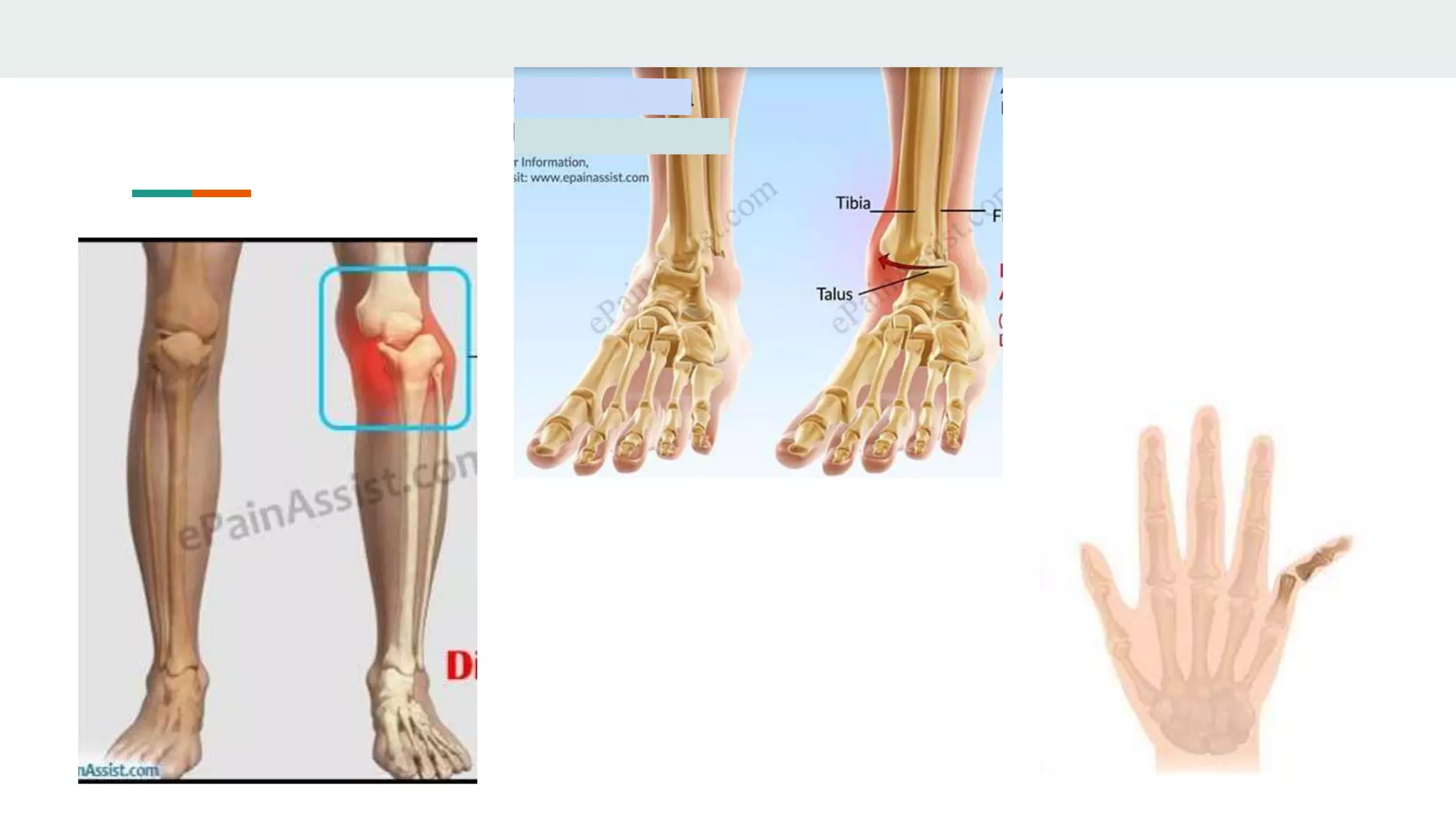 Common Injuries in the Skeletal System | PPT