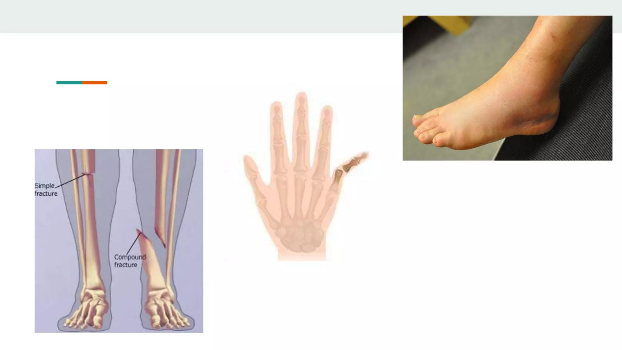 Common Injuries in the Skeletal System | PPT