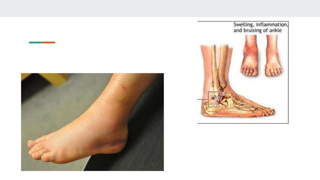 Common Injuries in the Skeletal System | PPTX